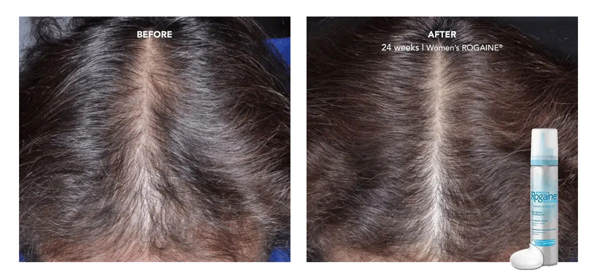 How ROGAINE® Works to Regrow Fuller Hair | ROGAINE®