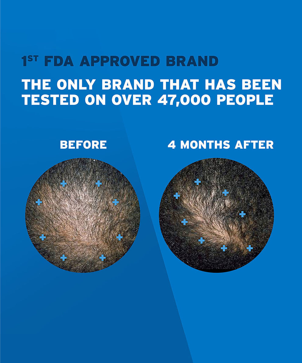 Men's ROGAINE® Foam, 5% Minoxidil Hair Regrowth Treatment | ROGAINE®