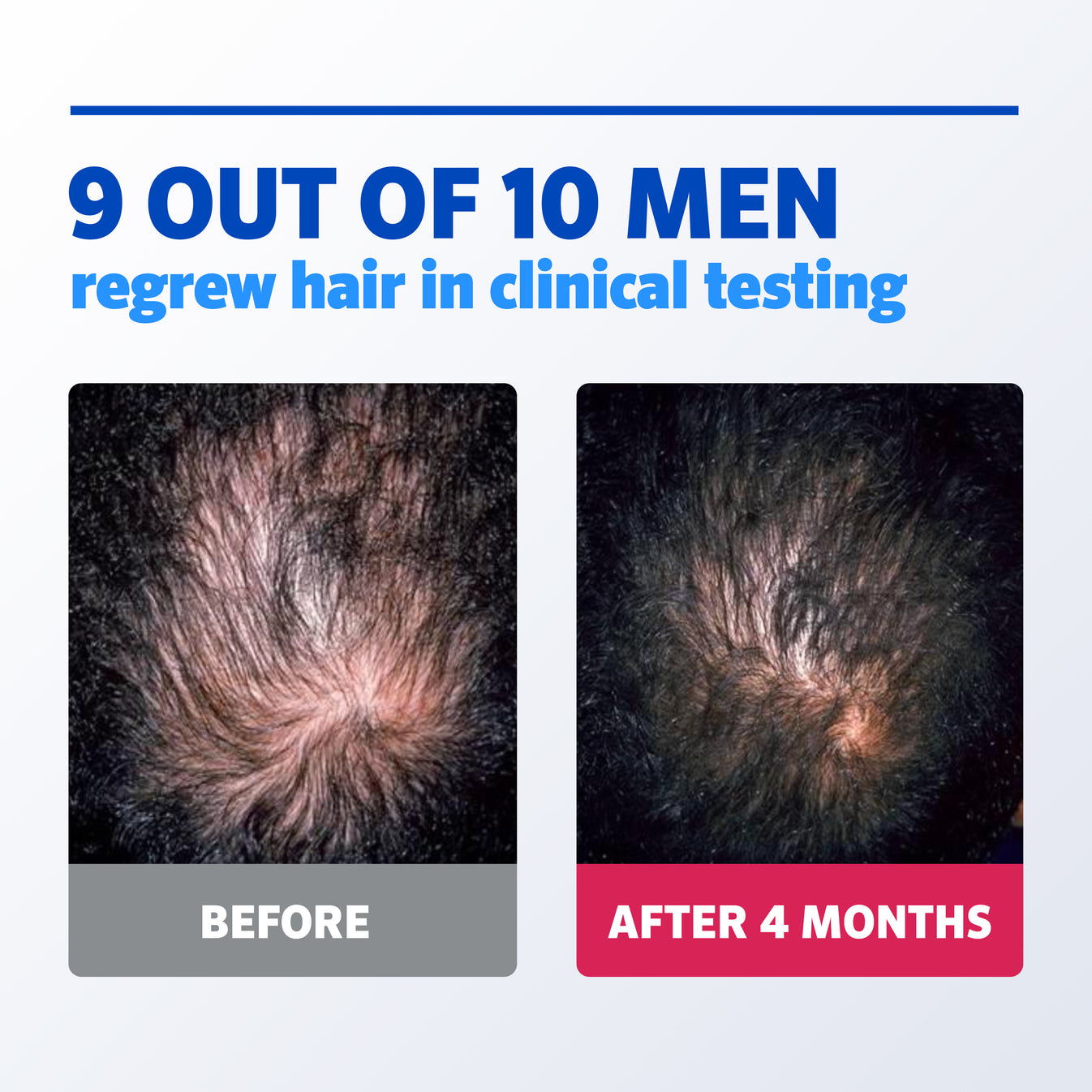 Men's ROGAINE® Foam, 5% Minoxidil Hair Regrowth Treatment | ROGAINE®