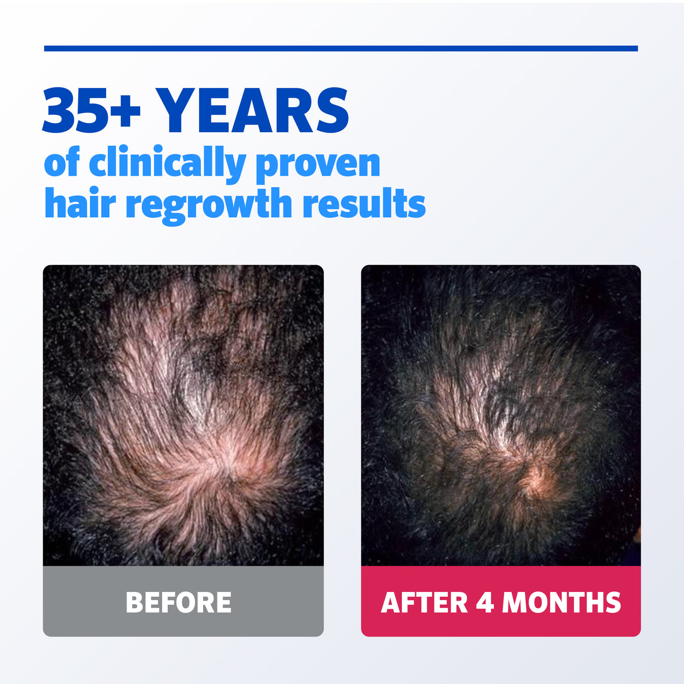 Men's ROGAINE® 5% Minoxidil Solution Hair Regrowth Treatment | ROGAINE®