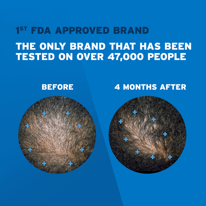 Men's ROGAINE® 5% Minoxidil Solution Hair Regrowth Treatment | ROGAINE®